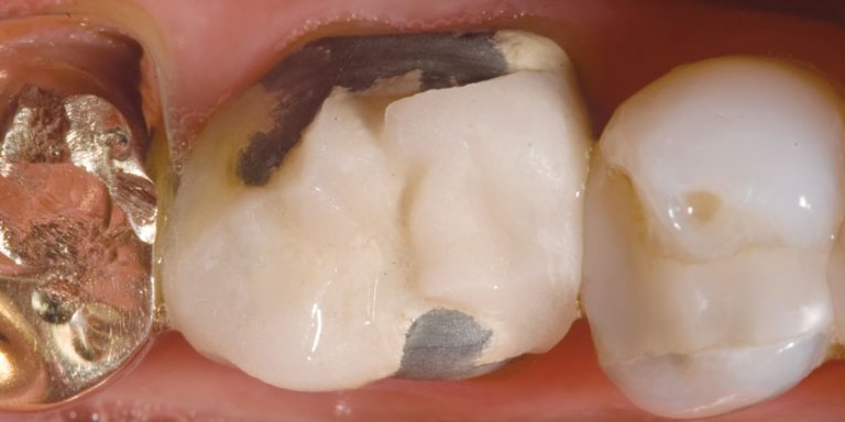 What is Occlusal Therapy and how can it improve gum health? - Britten Perio