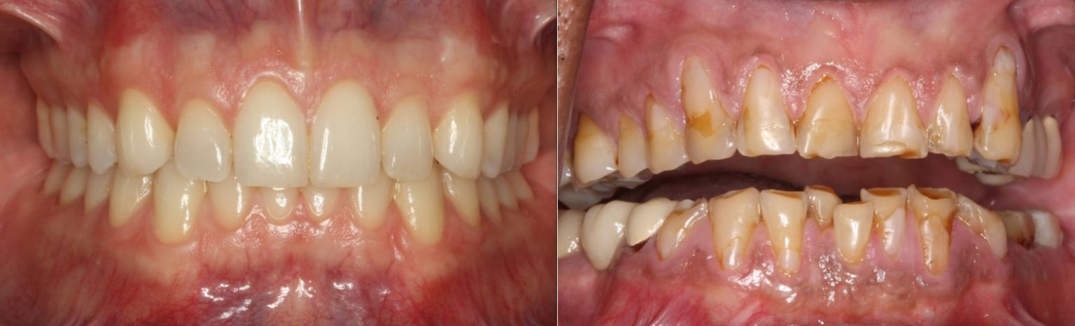 Healthy Teeth Vs. Acid Erosion & Wear - Britten Perio