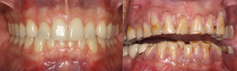 Healthy Teeth Vs. Acid Erosion & Wear - Britten Perio