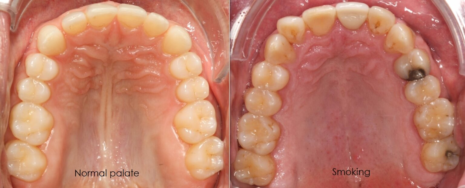 Tooth Wear: Why it Matters – Britten Perio