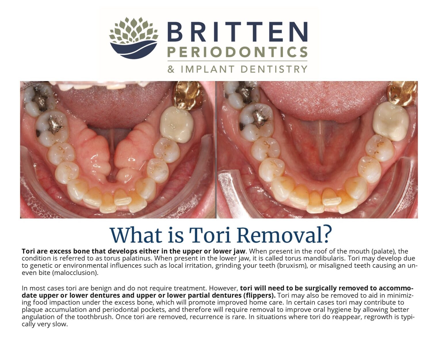 What is Tori Removal? - Britten Perio
