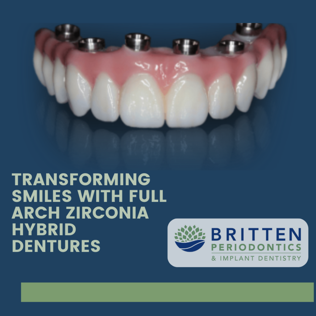 Clearwater periodontist Dr. Todd Britten Introduces Full Arch Zirconia ...