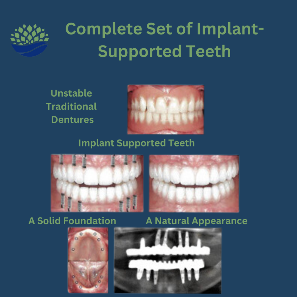 Restore Your Smile with Implant-Supported Teeth - Britten Perio