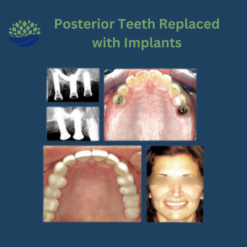 🦷 Missing Posterior Teeth? Dental Implants are the Solution! 🦷 - Britten Perio